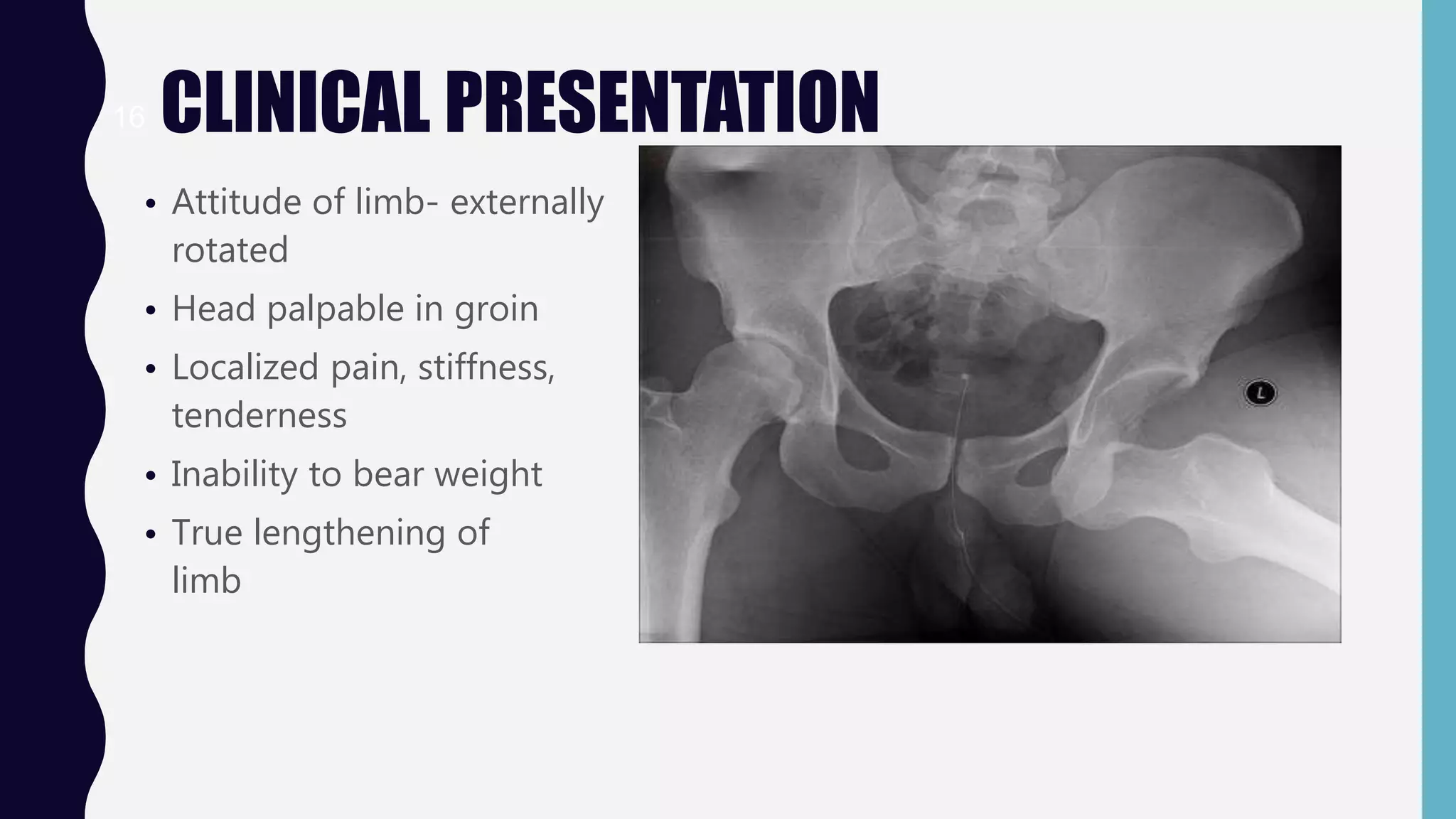 Injuries around hip joint | PPTX