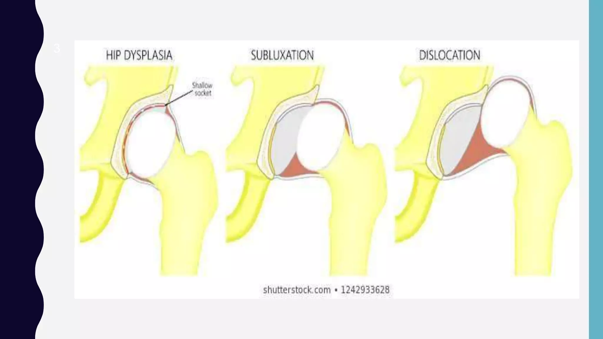 Injuries around hip joint | PPTX