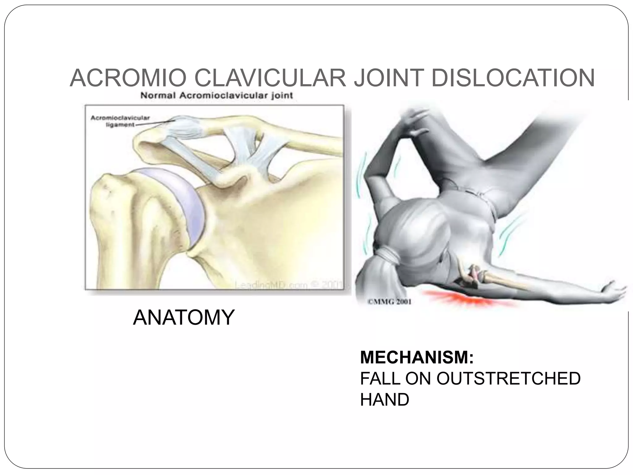 shoulder dislocation,scapula ,clavicle and all injuries around shoulder ...
