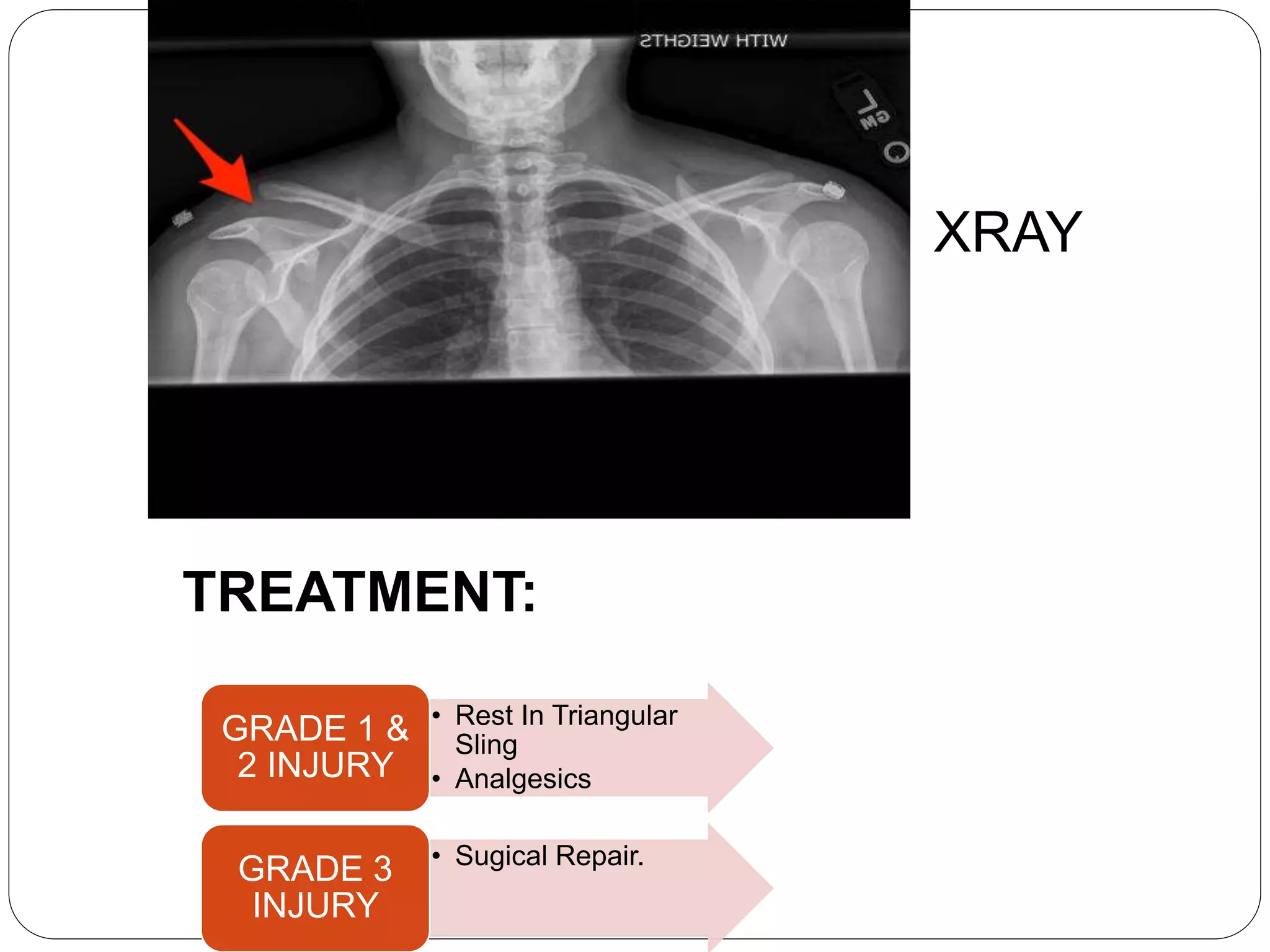 shoulder dislocation,scapula ,clavicle and all injuries around shoulder ...