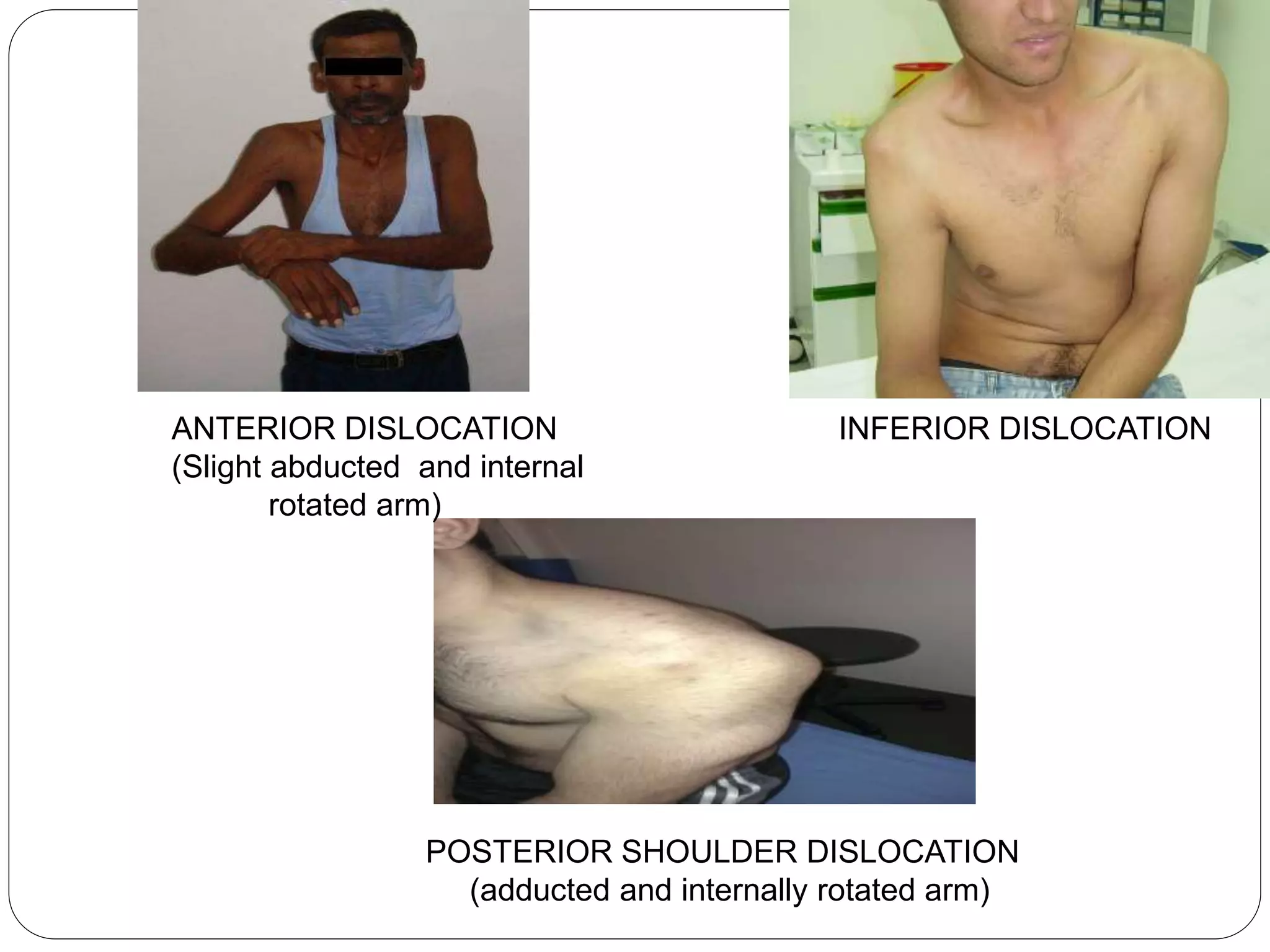 shoulder dislocation,scapula ,clavicle and all injuries around shoulder ...