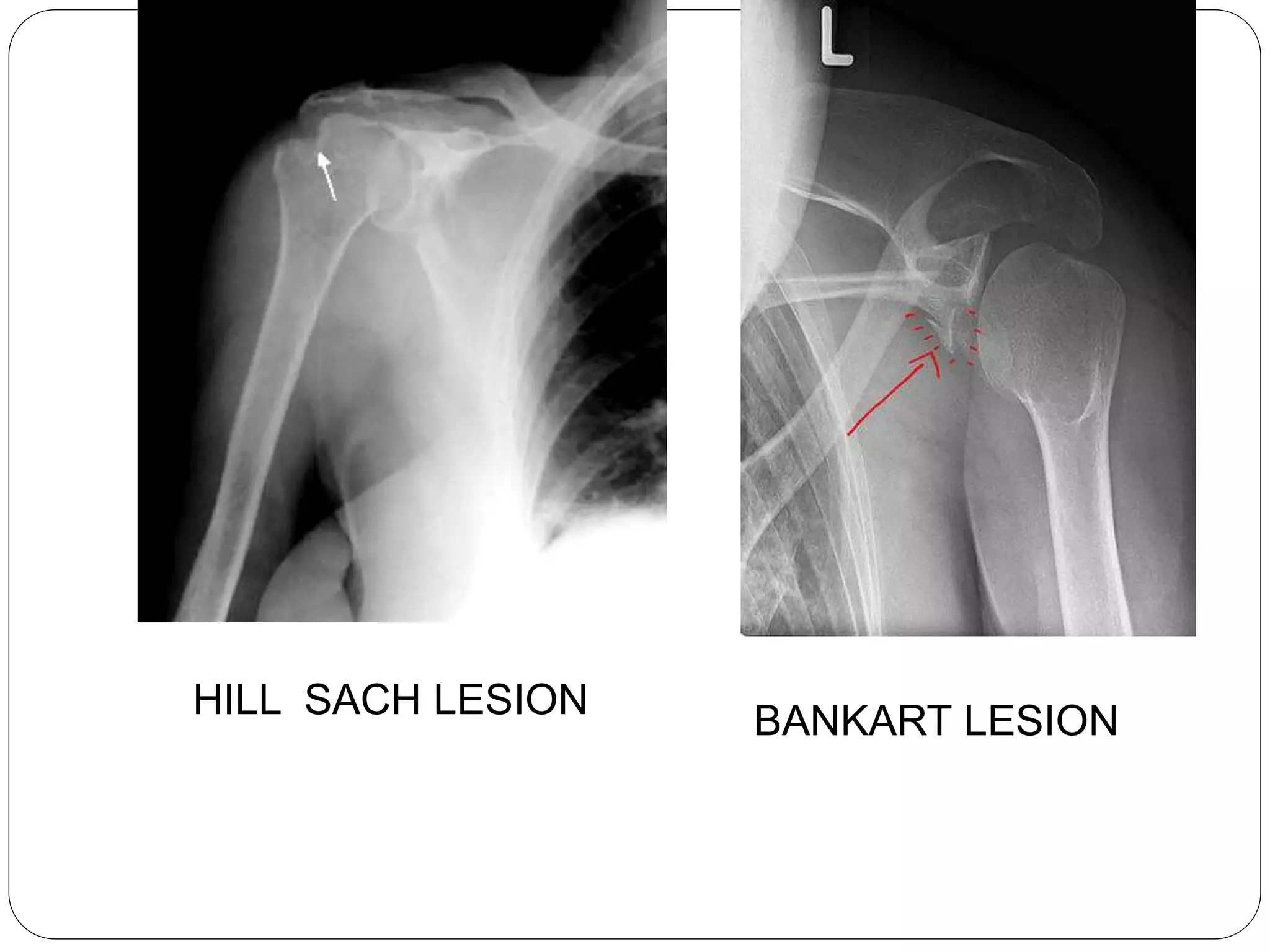 shoulder dislocation,scapula ,clavicle and all injuries around shoulder ...