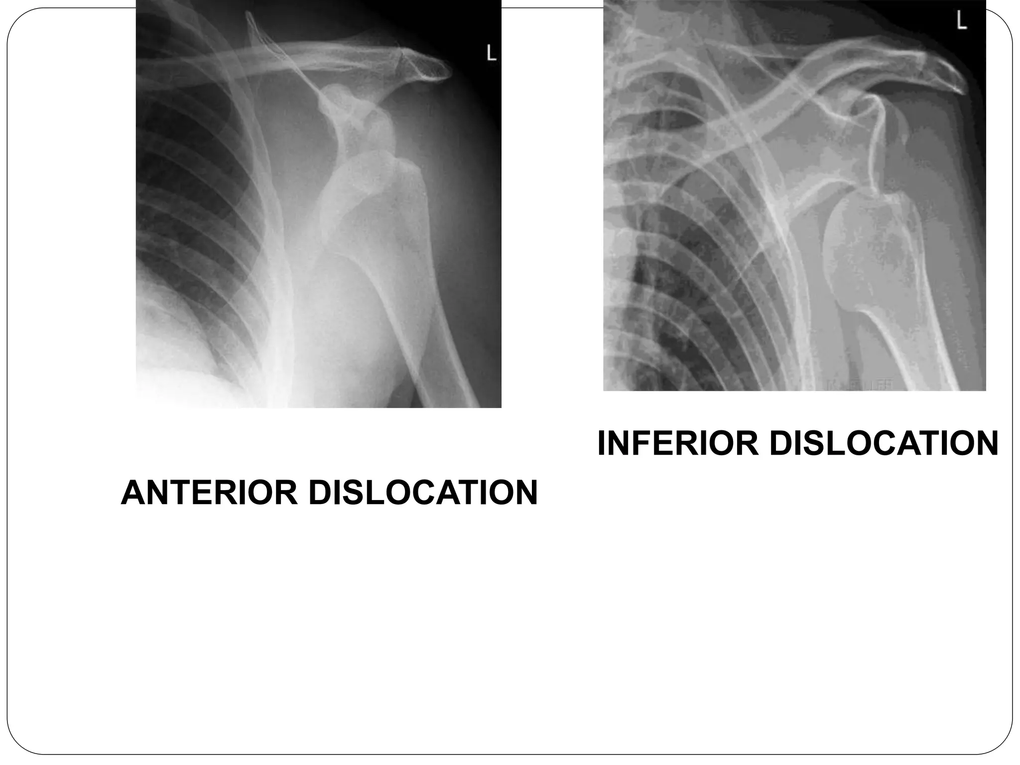 shoulder dislocation,scapula ,clavicle and all injuries around shoulder ...