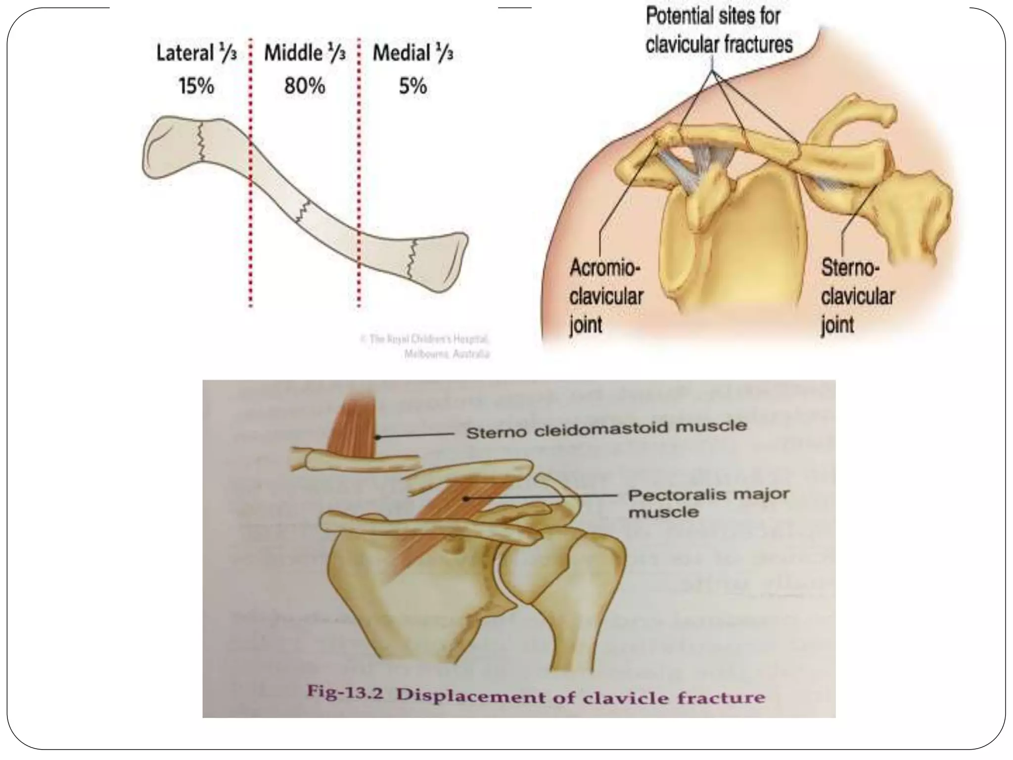 shoulder dislocation,scapula ,clavicle and all injuries around shoulder ...