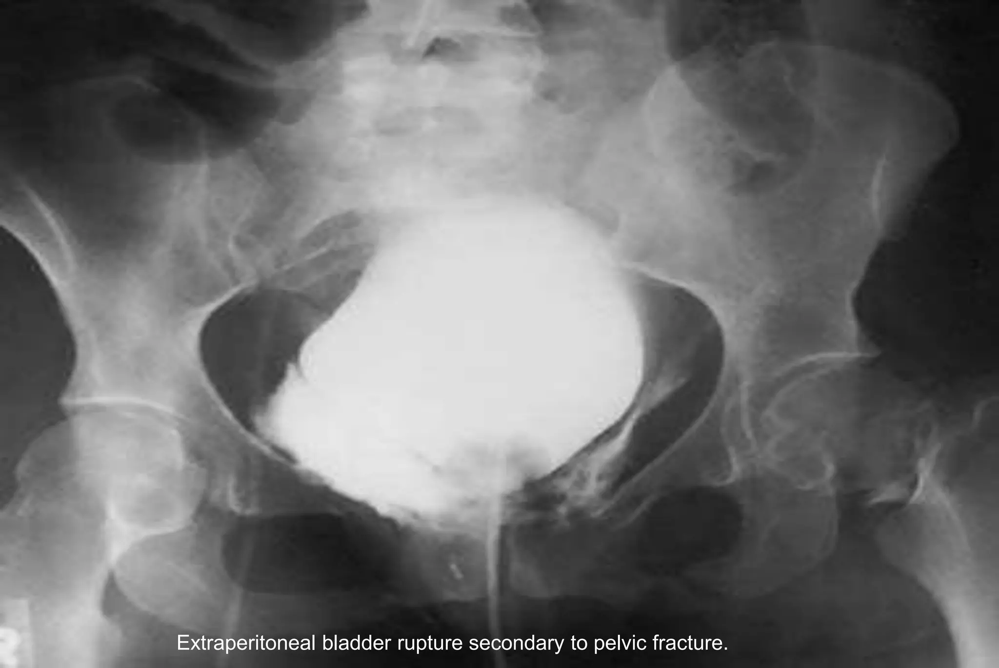 Urinary Bladder Injuries by Sayed Eleweedy | PPT