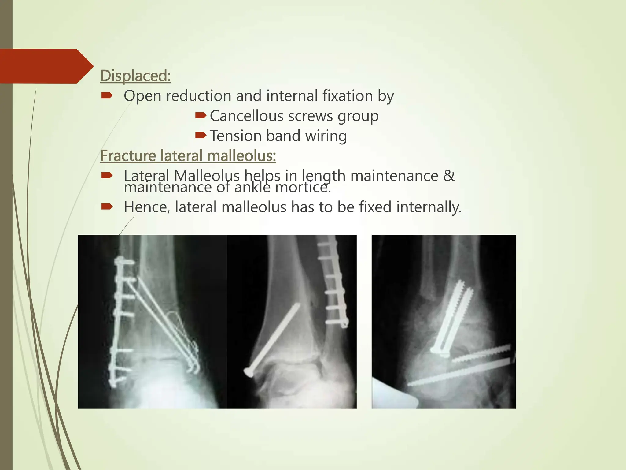 Injuries of the ankle joint which can occur | PPT
