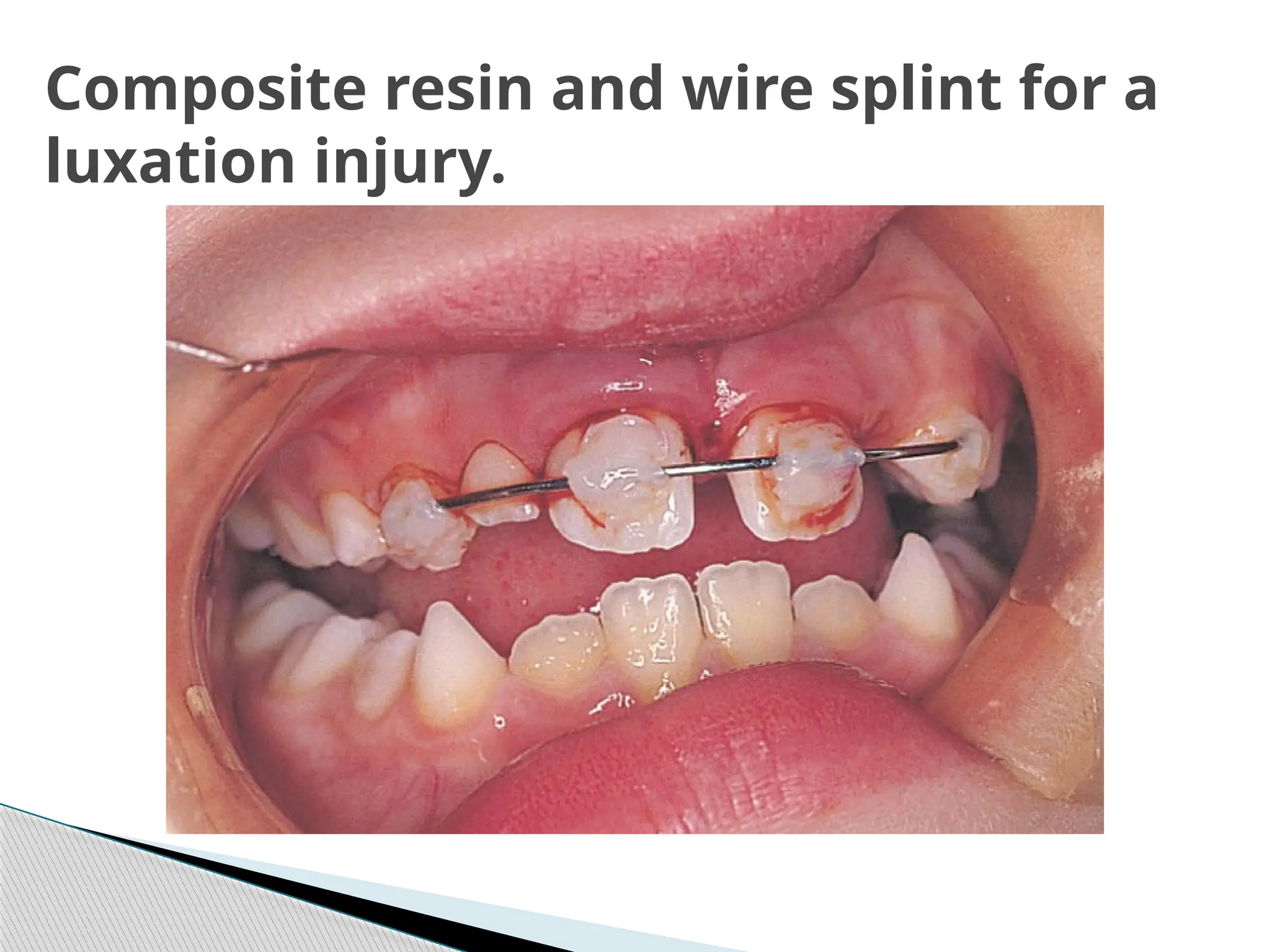 Injuries or Trauma in permanent dentition .pptx