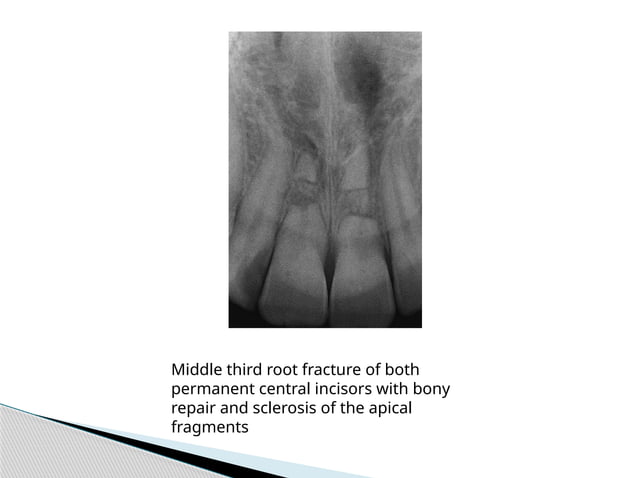 Injuries or Trauma in permanent dentition .pptx