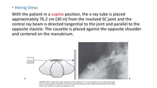 Injuries to the sternoclavicular joint | PPTX