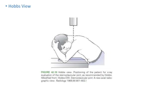 Injuries to the sternoclavicular joint | PPTX