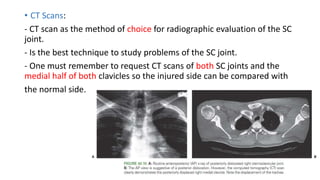 Injuries to the sternoclavicular joint | PPTX