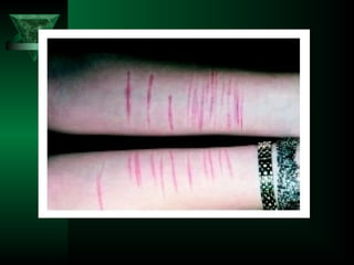 Hesitation Cuts