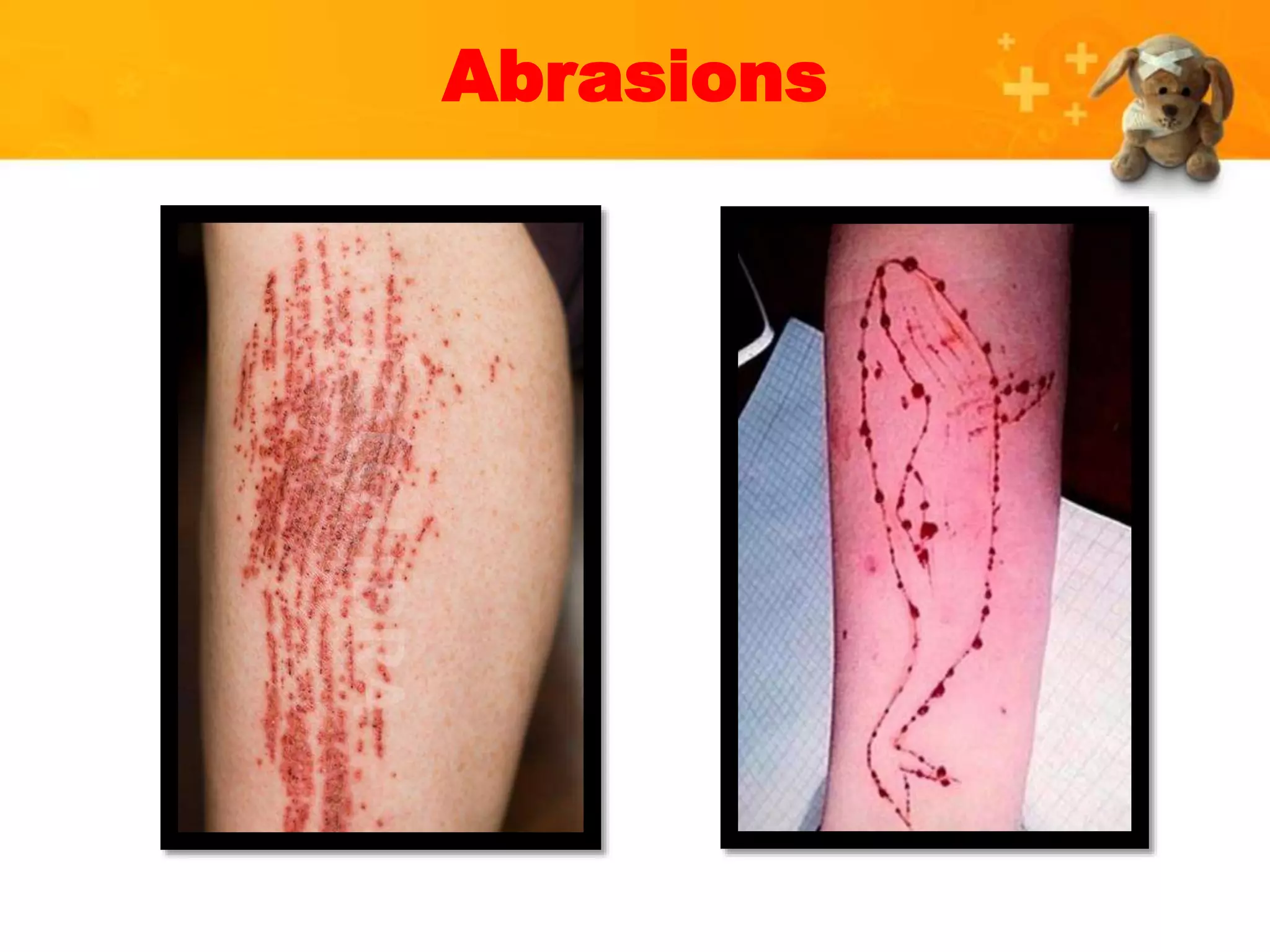 Injury (Forensic science) | PPTX