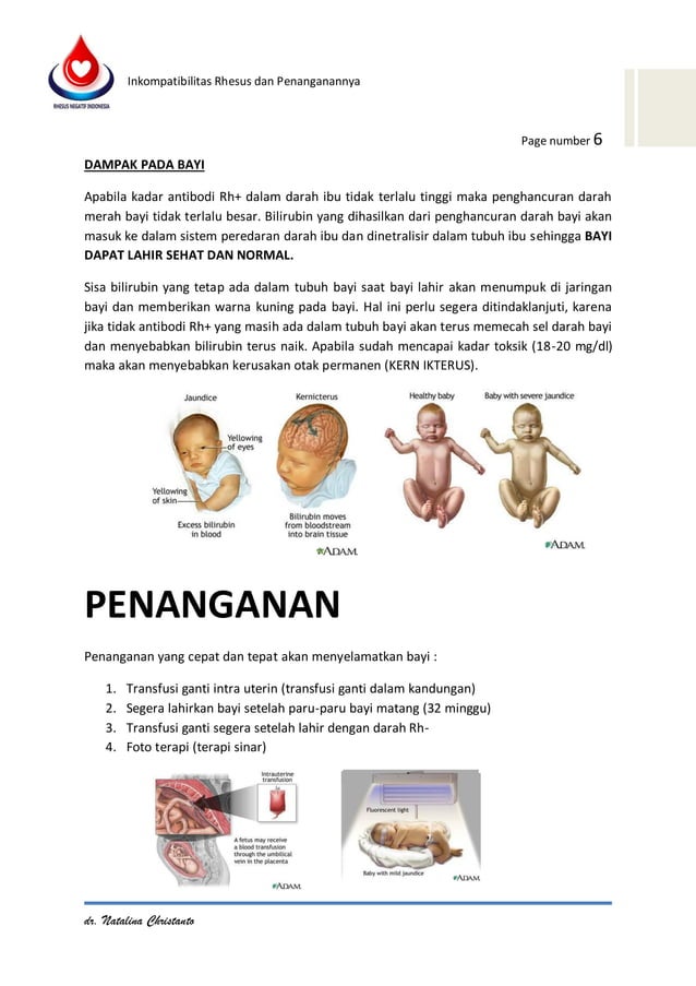 Inkompatibilitas Rhesus dan Penanganannya | PDF