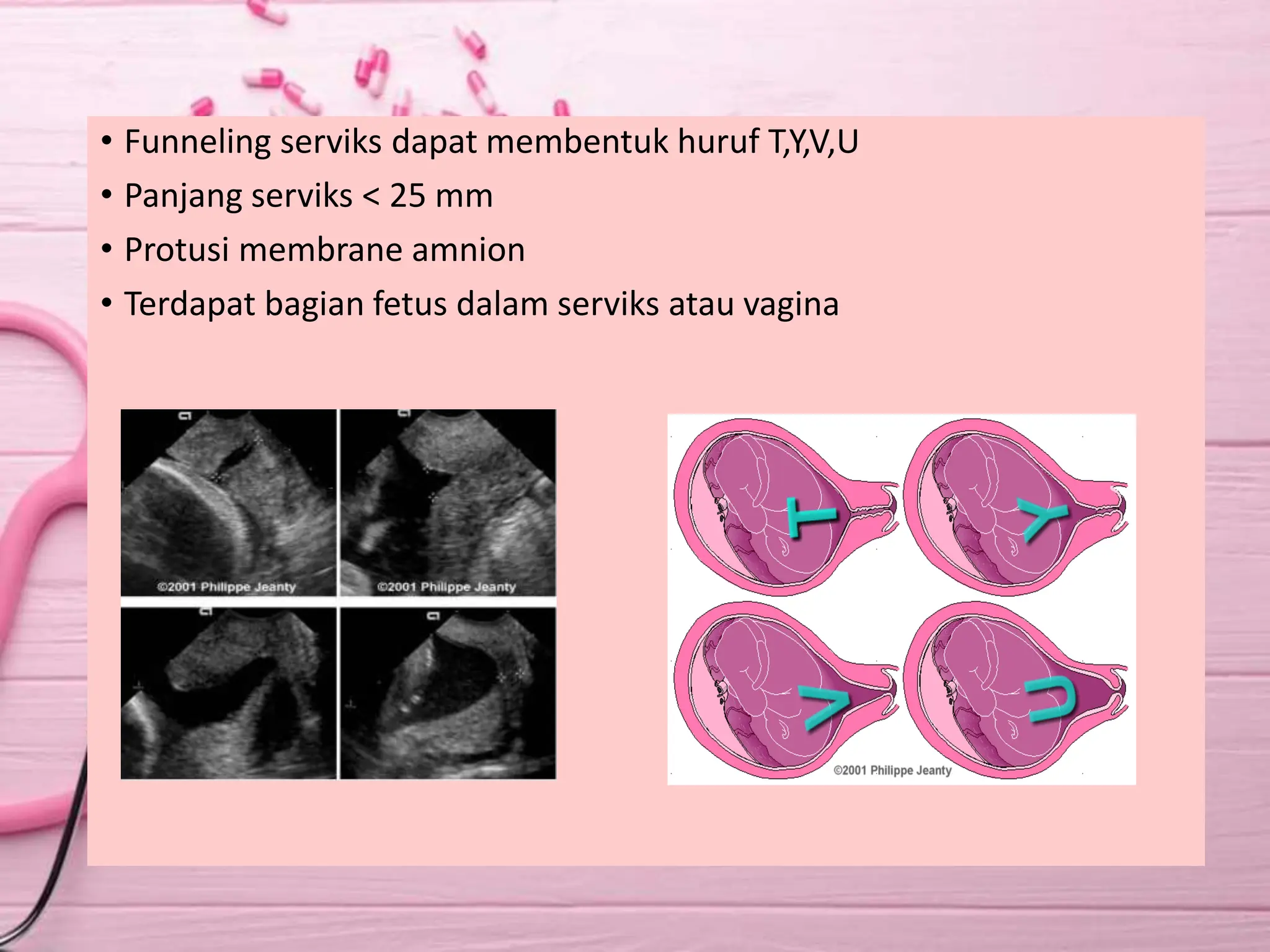 Inkompetensi Serviks - Wendy lobo & Jo.pptx