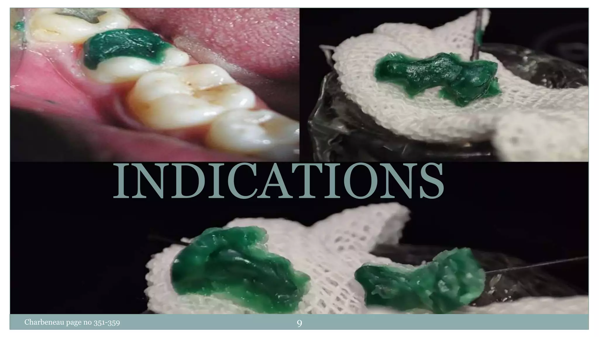 INLAY CAVITY PREPARATION seminaar.pptx