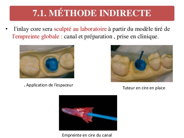 Faux Moignon Implantaire – Faux Moignon Dentaire Origine – LFMY