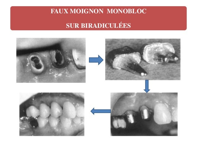 Inlay core et faux moignon 2
