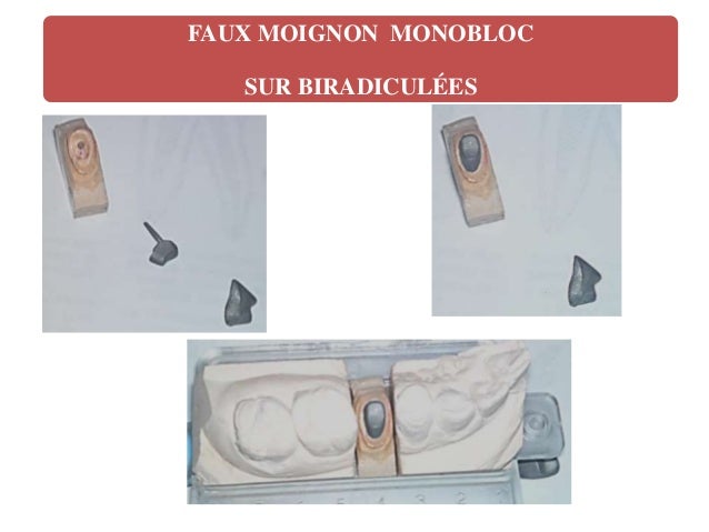 Inlay core et faux moignon 2