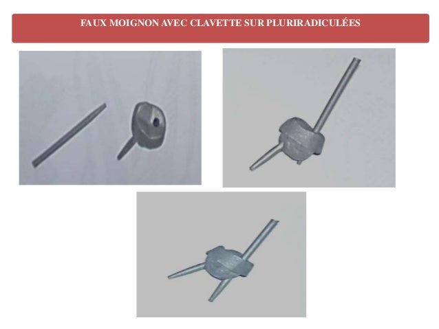 Inlay core et faux moignon 2