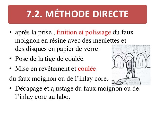 Inlay core et faux moignon 2