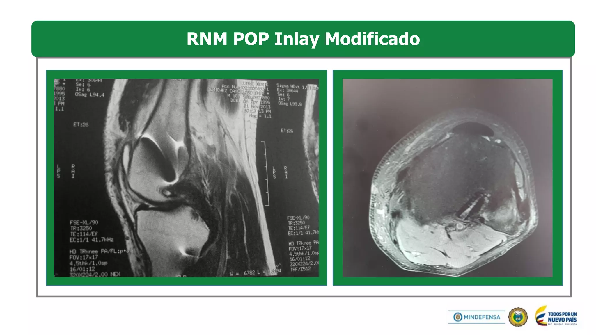 Inlay modificado fijacion tibial dr afanador 2020 | PPT