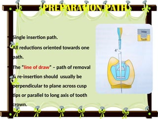 Inlay Nupur important for dental students | PPTX
