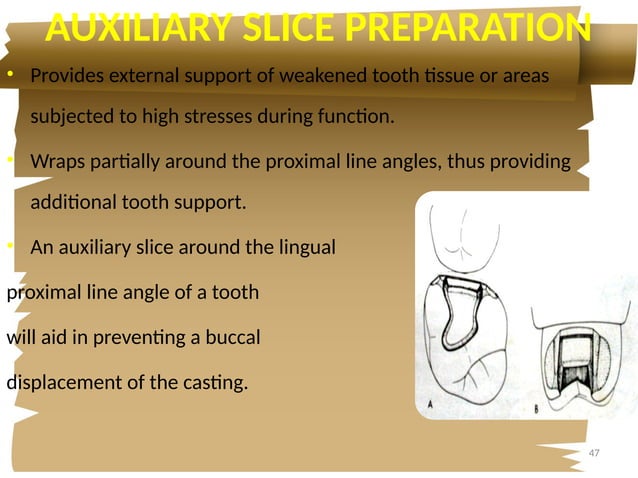 Inlay Nupur important for dental students | PPT