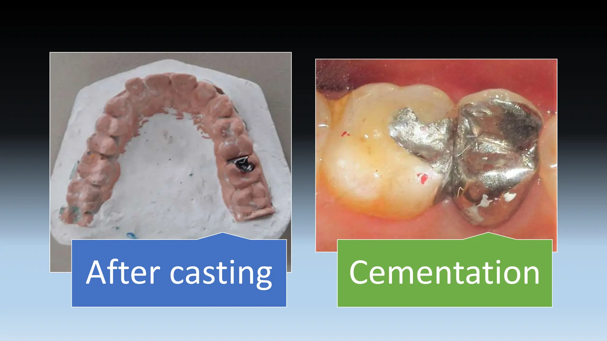 Inlay cavity preparation by direct and indirect method for the ...