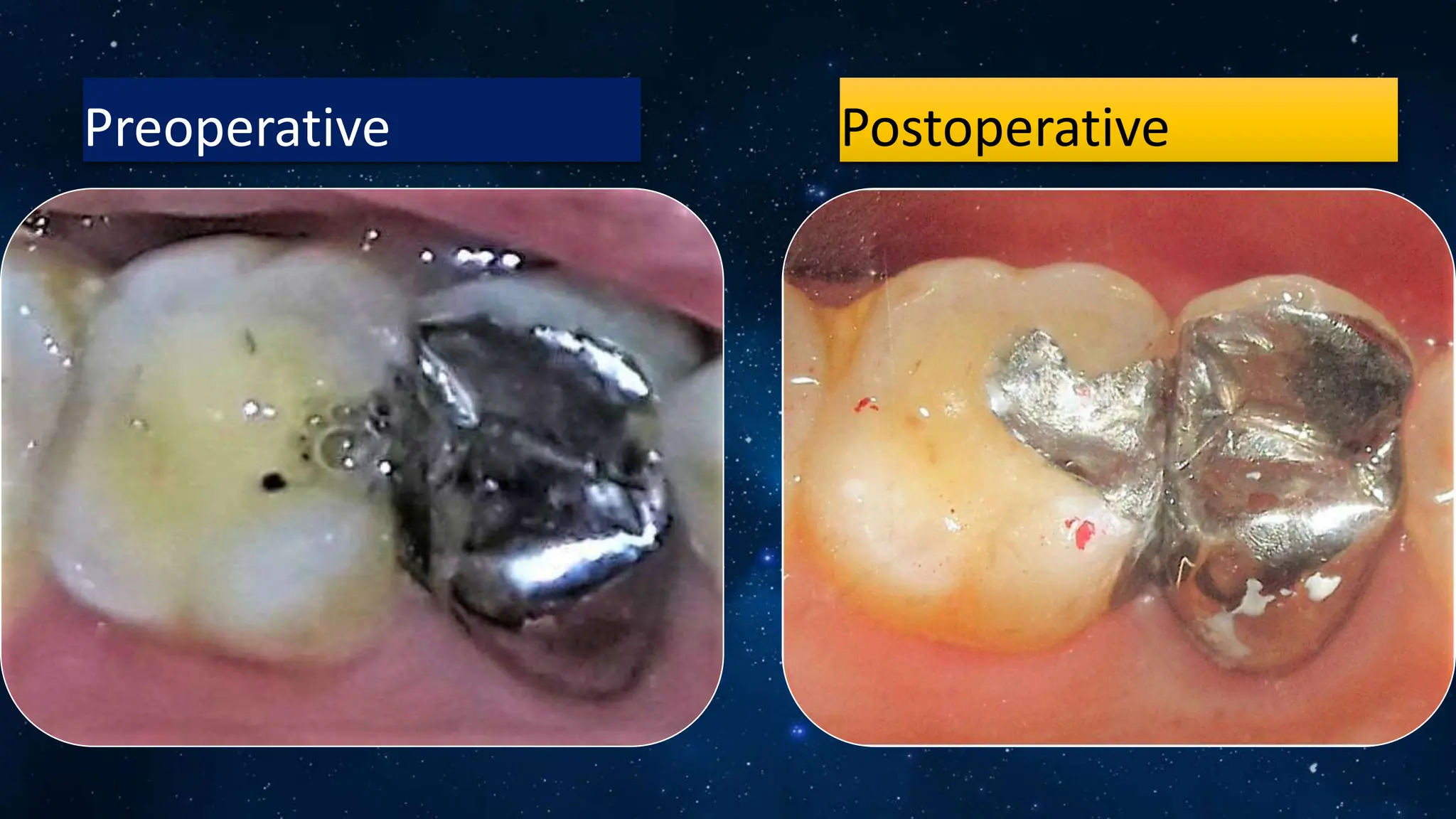 Inlay cavity preparation by direct and indirect method for the ...