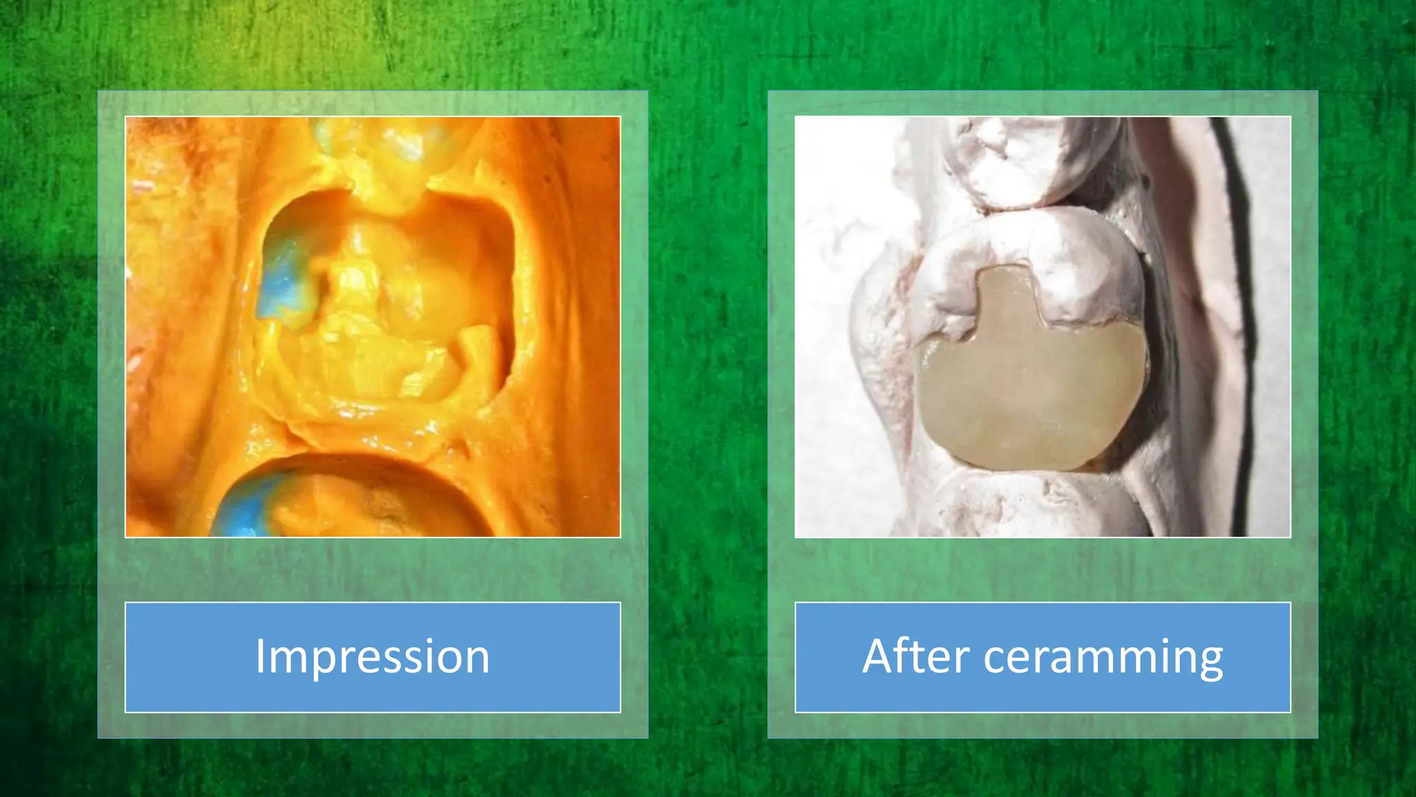 Inlay cavity preparation by direct and indirect method for the ...