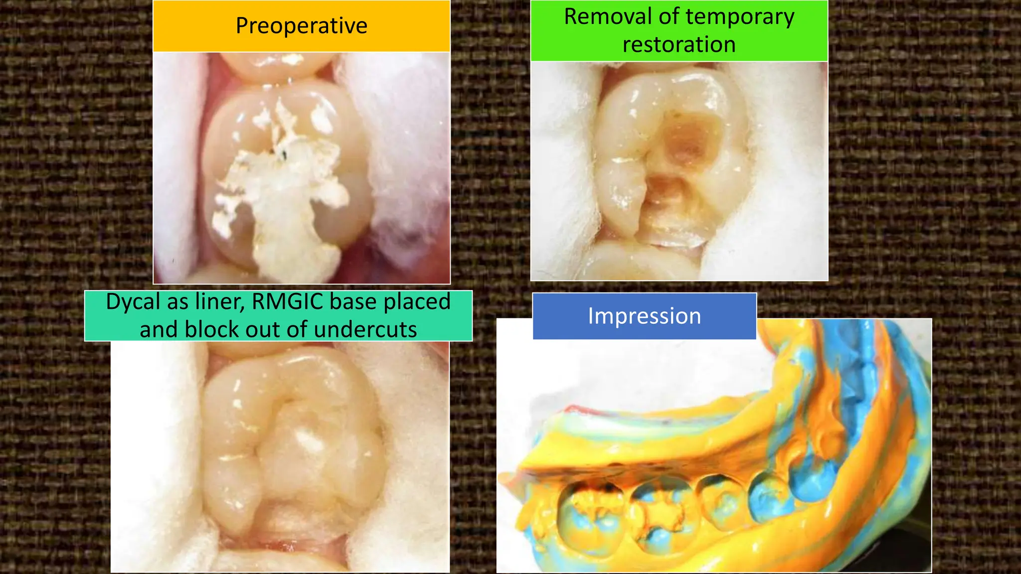 Inlay cavity preparation by direct and indirect method for the ...