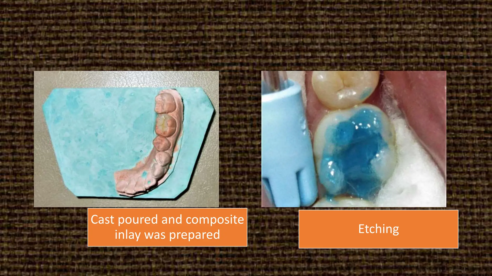 Inlay cavity preparation by direct and indirect method for the ...
