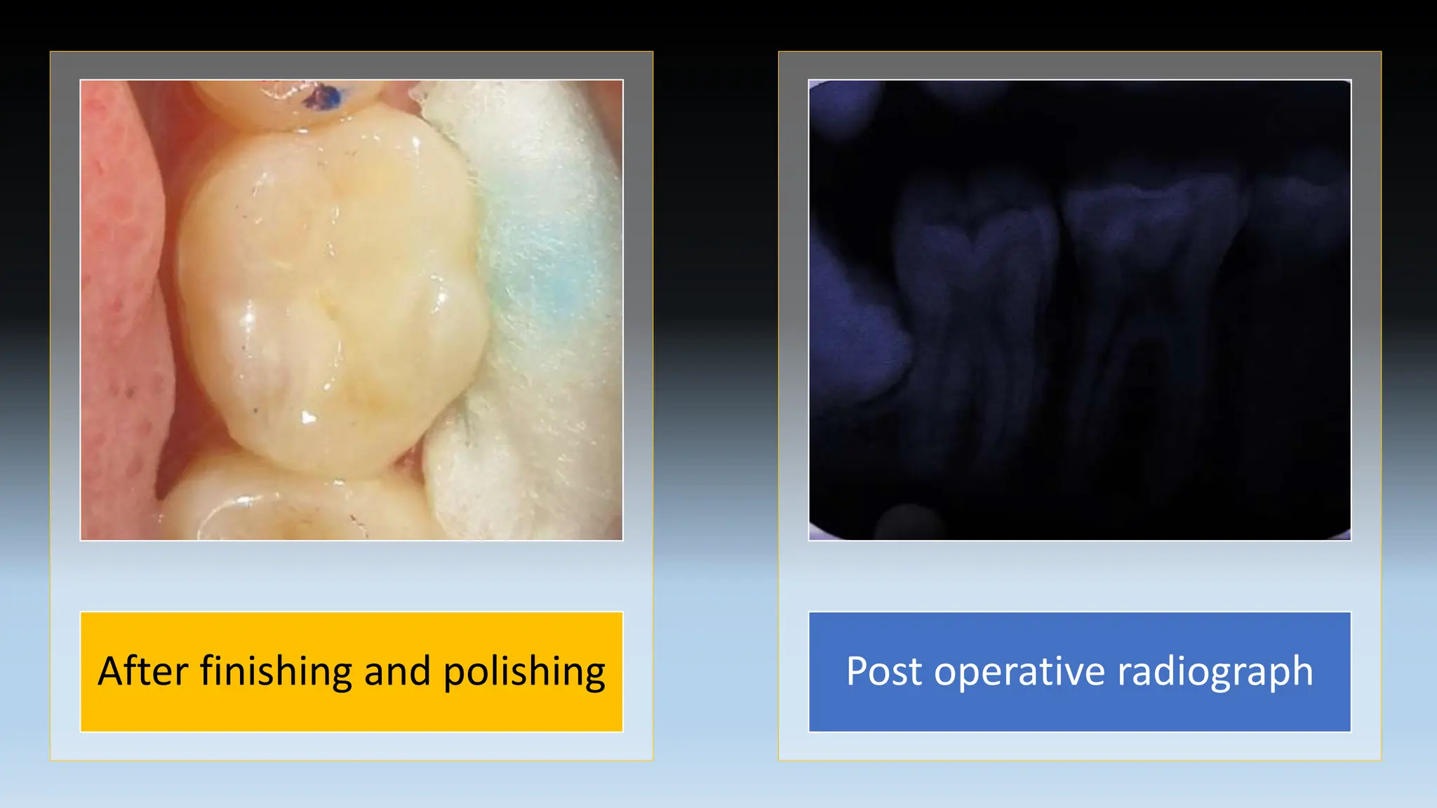 Inlay cavity preparation by direct and indirect method for the ...