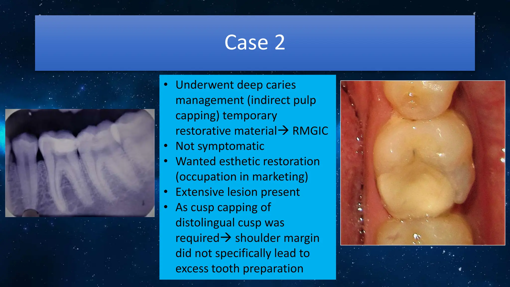 Inlay cavity preparation by direct and indirect method for the ...