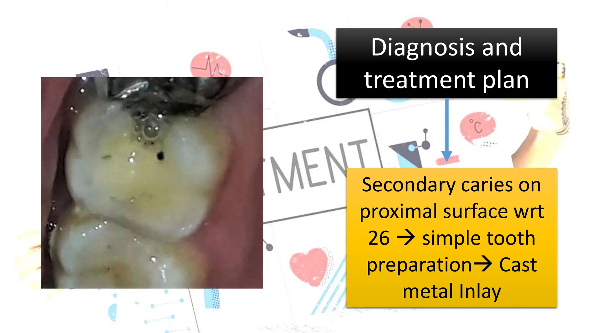 Inlay cavity preparation by direct and indirect method for the ...