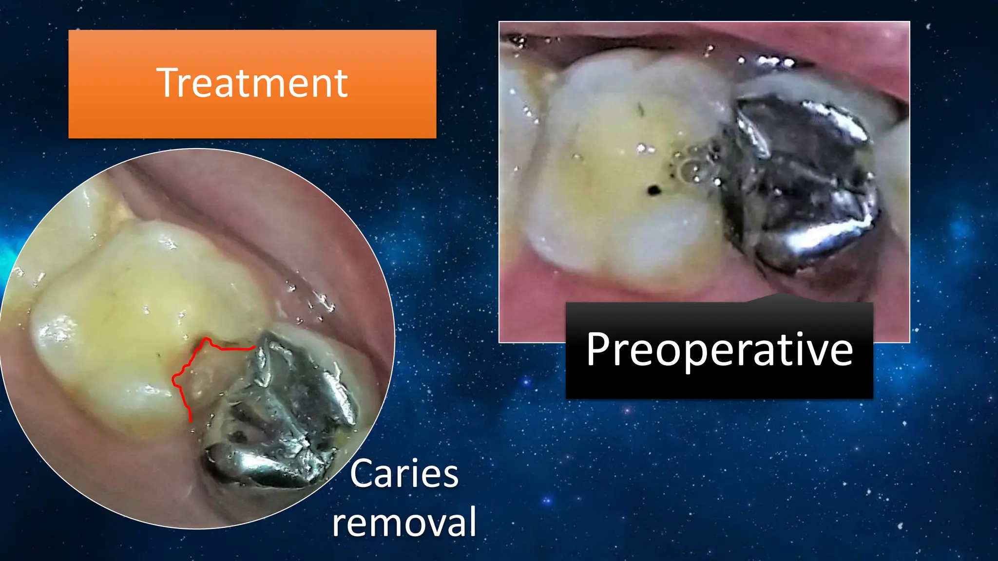 Inlay cavity preparation by direct and indirect method for the ...