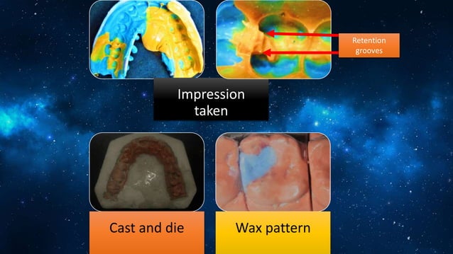 Inlay cavity preparation by direct and indirect method for the ...