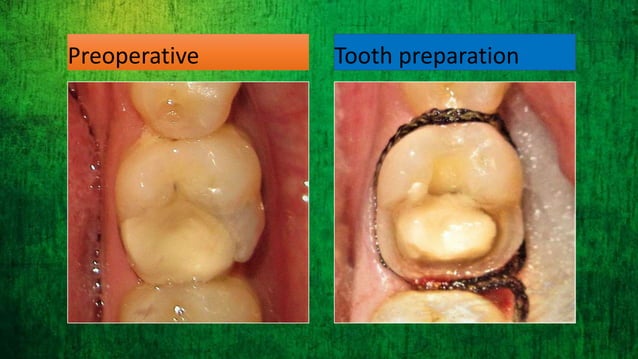Inlay cavity preparation by direct and indirect method for the ...