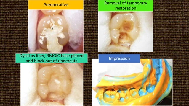 Inlay cavity preparation by direct and indirect method for the ...