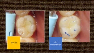 Inlay cavity preparation by direct and indirect method for the ...