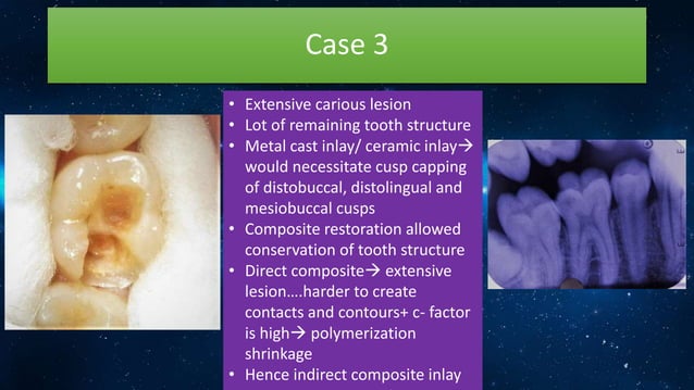 Inlay cavity preparation by direct and indirect method for the ...