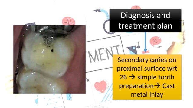 Inlay cavity preparation by direct and indirect method for the ...
