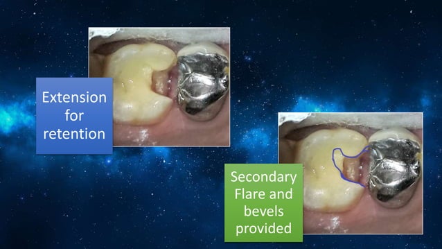 Inlay cavity preparation by direct and indirect method for the ...