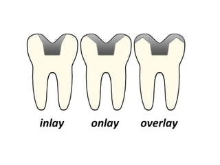 Inlays onlays2 | PPTX