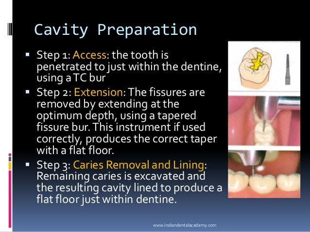 Inlays and onlays. / implant dentistry course/ implant dentistry cour…