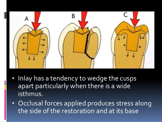Inlays and onlays / implant dentistry course/ implant dentistry course