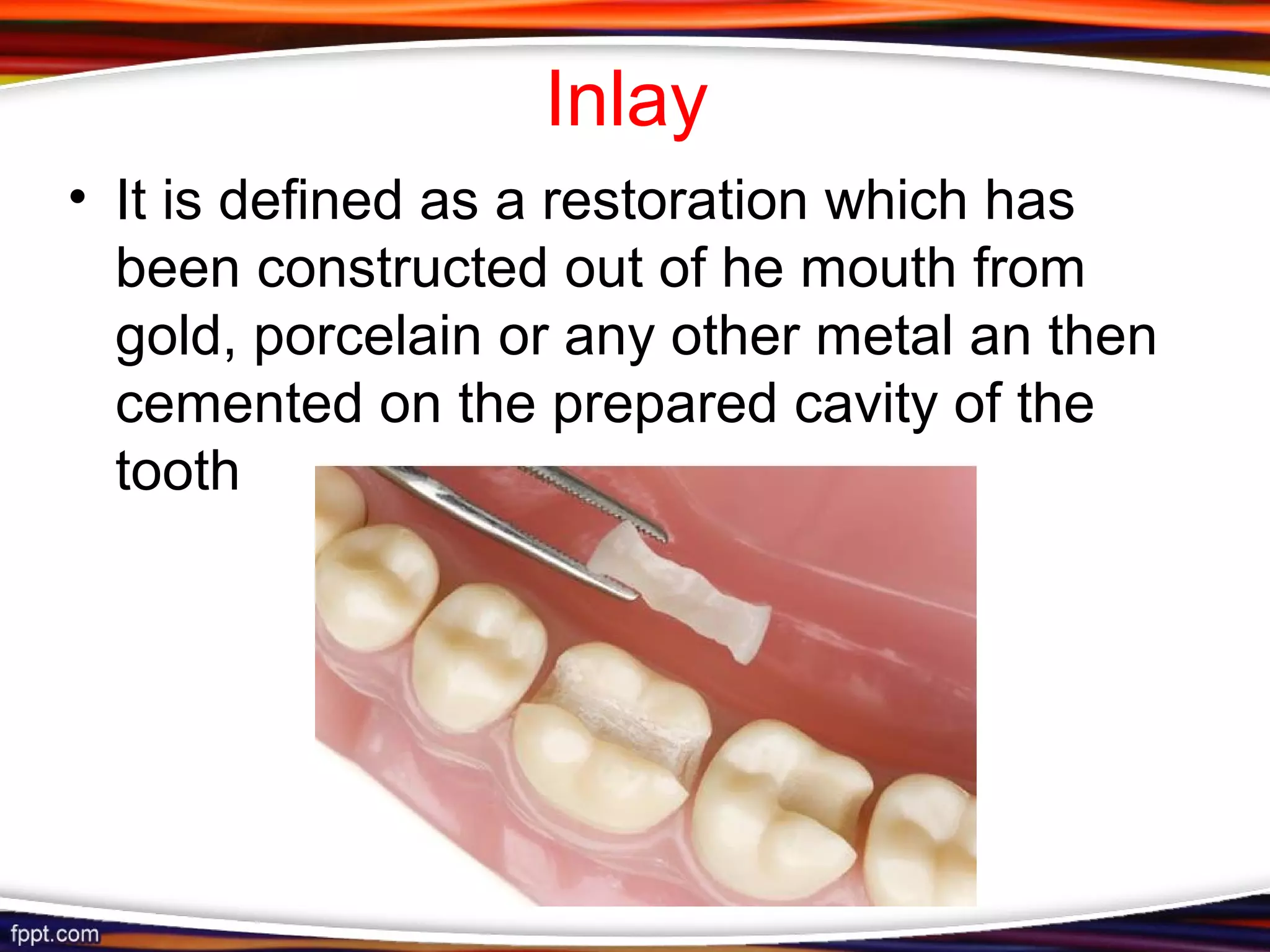 Inlays and onlays | PPT