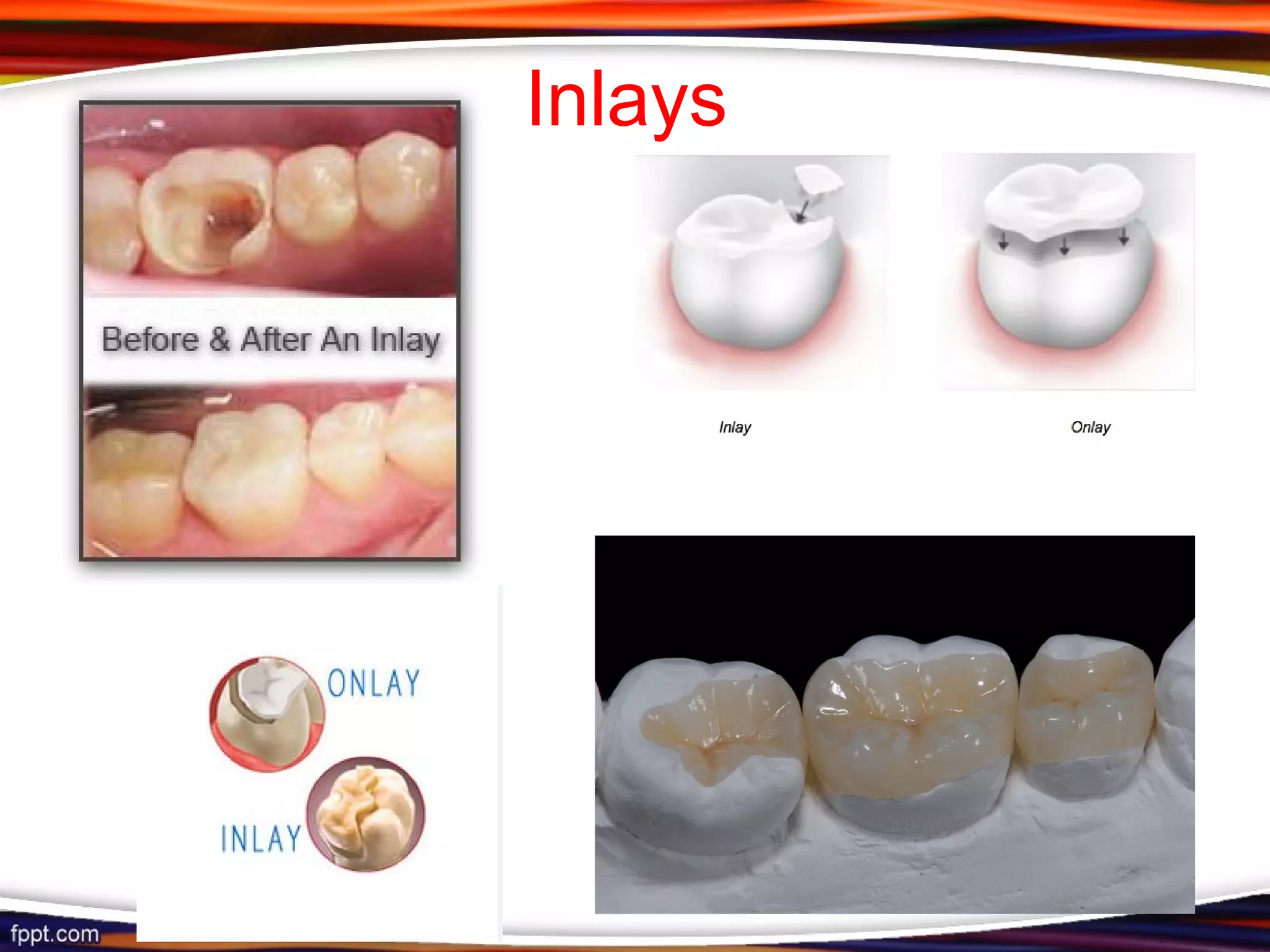 Inlays and onlays | PPT