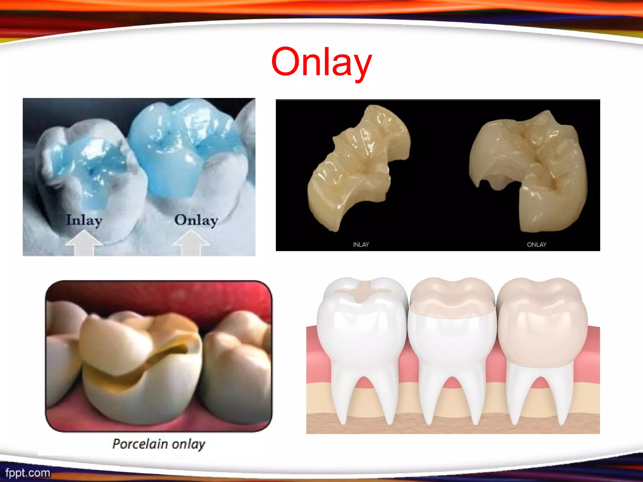 Inlays and onlays | PPT